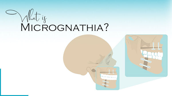 What Is Micrognathia? - GREAT ORAL HEALTH