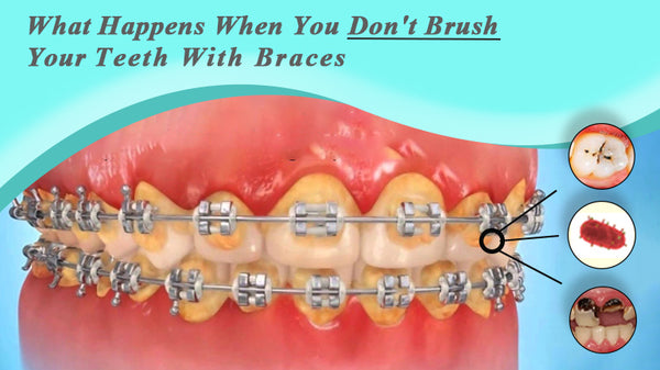 What Happens When You Don't Brush Your Teeth With Braces - GREAT ORAL ...